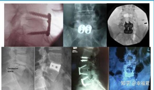 UBE 这些差别你知道吗？PLF PLIF TLIF DLIF XLIF 手术技术对比【医术苑】科普 - 知乎