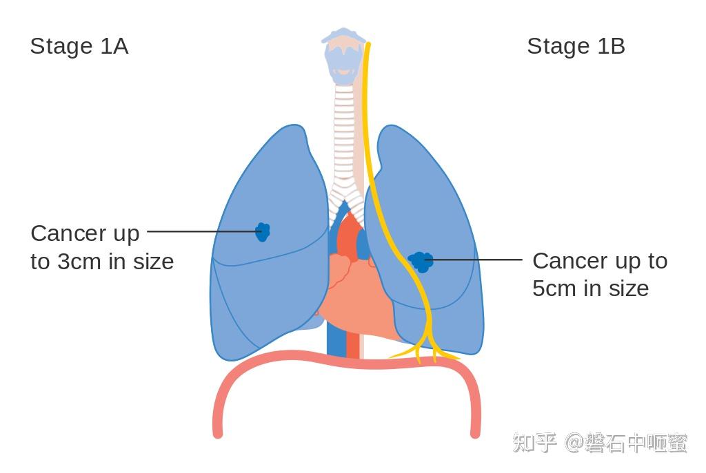 肺癌 Lung cancer - 知乎