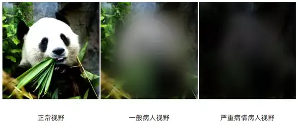 十年磨一剑 | 中国首个获得FDA临床试验许可的眼科体内基因治疗药物 - 知乎