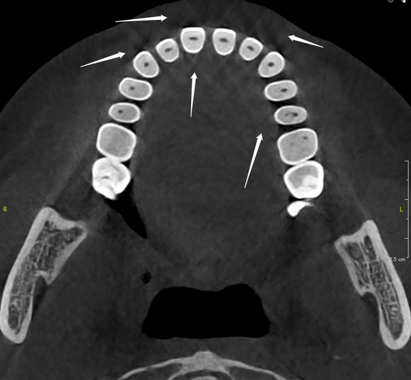 CBCT上空的乌云（1）—— 数据完备性与射线硬化 - 知乎