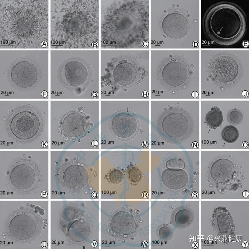 《卵胞质内单精子注射（ICSI）技术中国专家共识（2023年）》解读 - 知乎