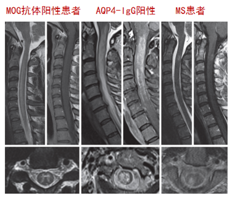 难倒大部分神内医生的MOG抗体病，8大临床表型一文掌握 - 知乎