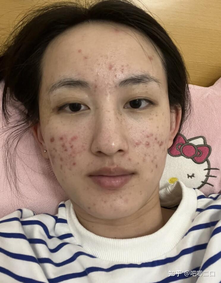 记录我的红褐色痘印完全去除成功经历(已不影响我生活) 知乎