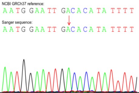 案例分享 | 罕见病基因诊断——CHARGE 综合征 - 知乎