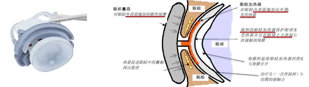 “这个LipiFlow治干眼太棒了，治一次能顶大半年” - 知乎