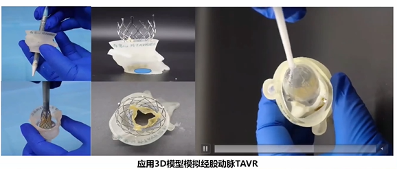 杨剑教授：心血管3D打印技术在结构性心脏病介入治疗中的应用 - 知乎