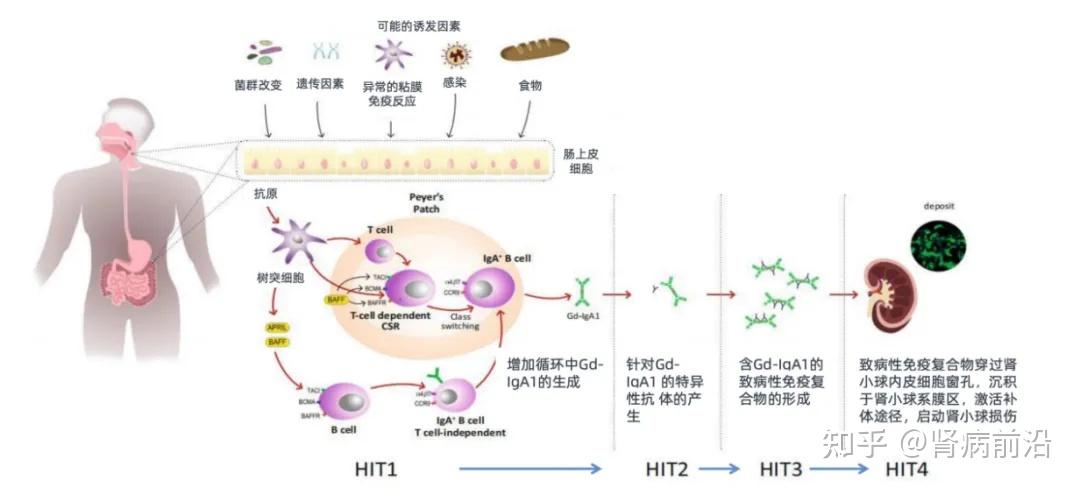 IIGANN-China | 新证据，新视角，新思维，探索APRIL在IgA肾病发病机制中的角色 - 知乎