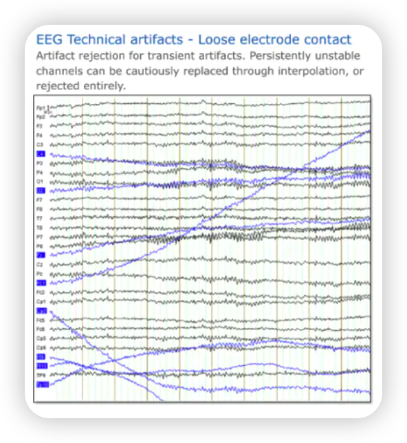常见EEG伪迹波形图（基于analyzer分析软件展示） - 知乎