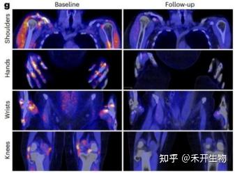 小禾说 | 自身免疫疾病靶点与模型系列(16)——CD3-TCE爆火，自免双抗/多抗疗法进入新阶段 - 知乎