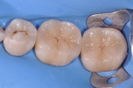 Composite onlays - 知乎