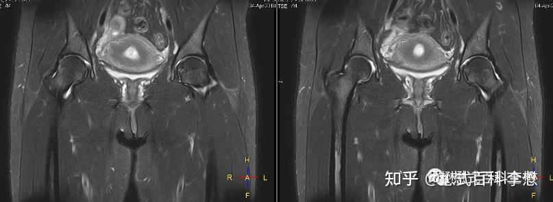 （双）髋关节磁共振扫描规范及临床应用 - 知乎