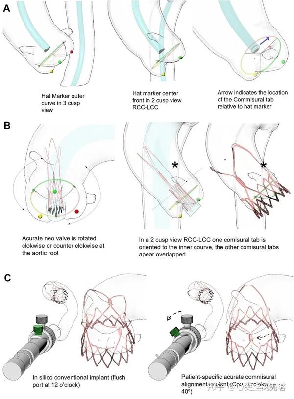 连合对齐（Commissural Alignment）：原理、定义、技术和结果（上） - 知乎