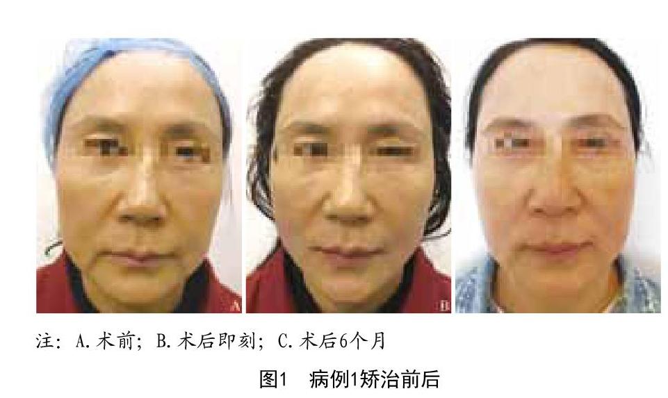 知乎盐选 | PPDO 双向锯齿线皮下埋置面部提升术的临床应用