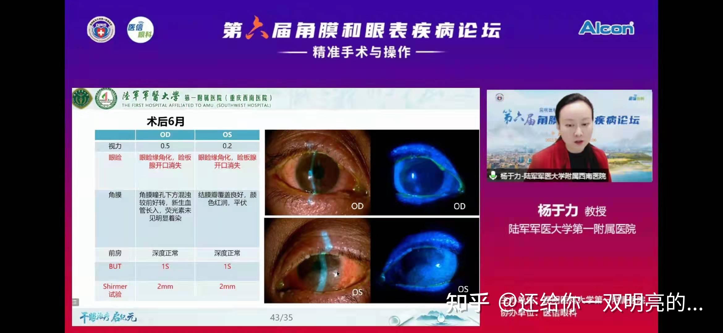 专家讲解强脉冲光（IPL）治疗干眼的临床应用 - 知乎