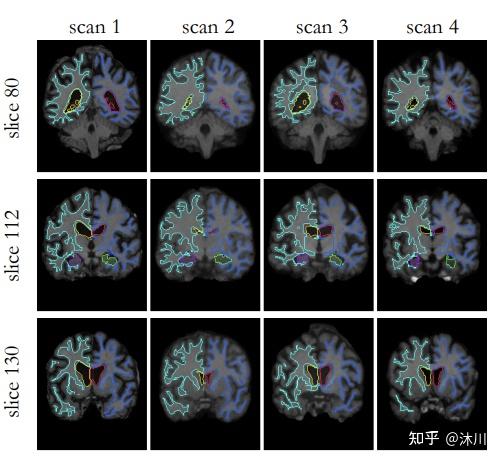 图像配准-VoxelMorph - 知乎
