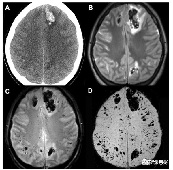 磁敏感加权成像（SWI)：技术要点和临床神经学应用 - 知乎