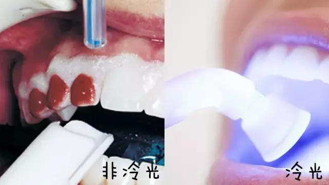 牙齿冷光美白效果怎么样？ 知乎