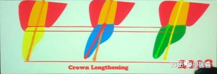 美学新花招：BOPT牙体预备 - 知乎