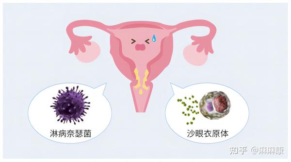 为什么女性容易得阴道炎、宫颈炎、盆腔炎？妇科炎症该怎么预防？ 知乎