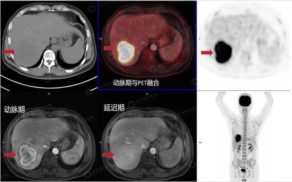 肝脏占位难定性，PET/CT-MR异机融合鉴良恶！ - 知乎