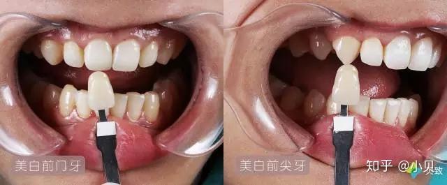 牙齿美白丨冷光美白的原理是什么?效果究竟如何? 知乎