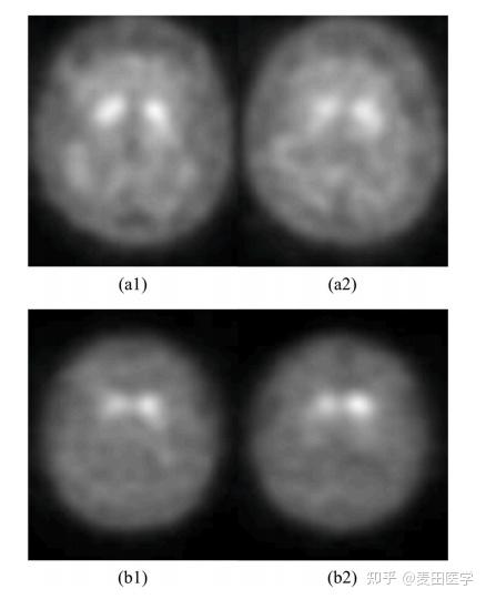 文献速递：深度学习--应用深度学习到DaTscan SPECT图像以改善帕金森病运动结果预测 - 知乎