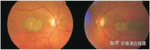Avacincaptad Pegol获FDA治疗地理萎缩的突破性疗法资格，上市申请即将完成 - 知乎