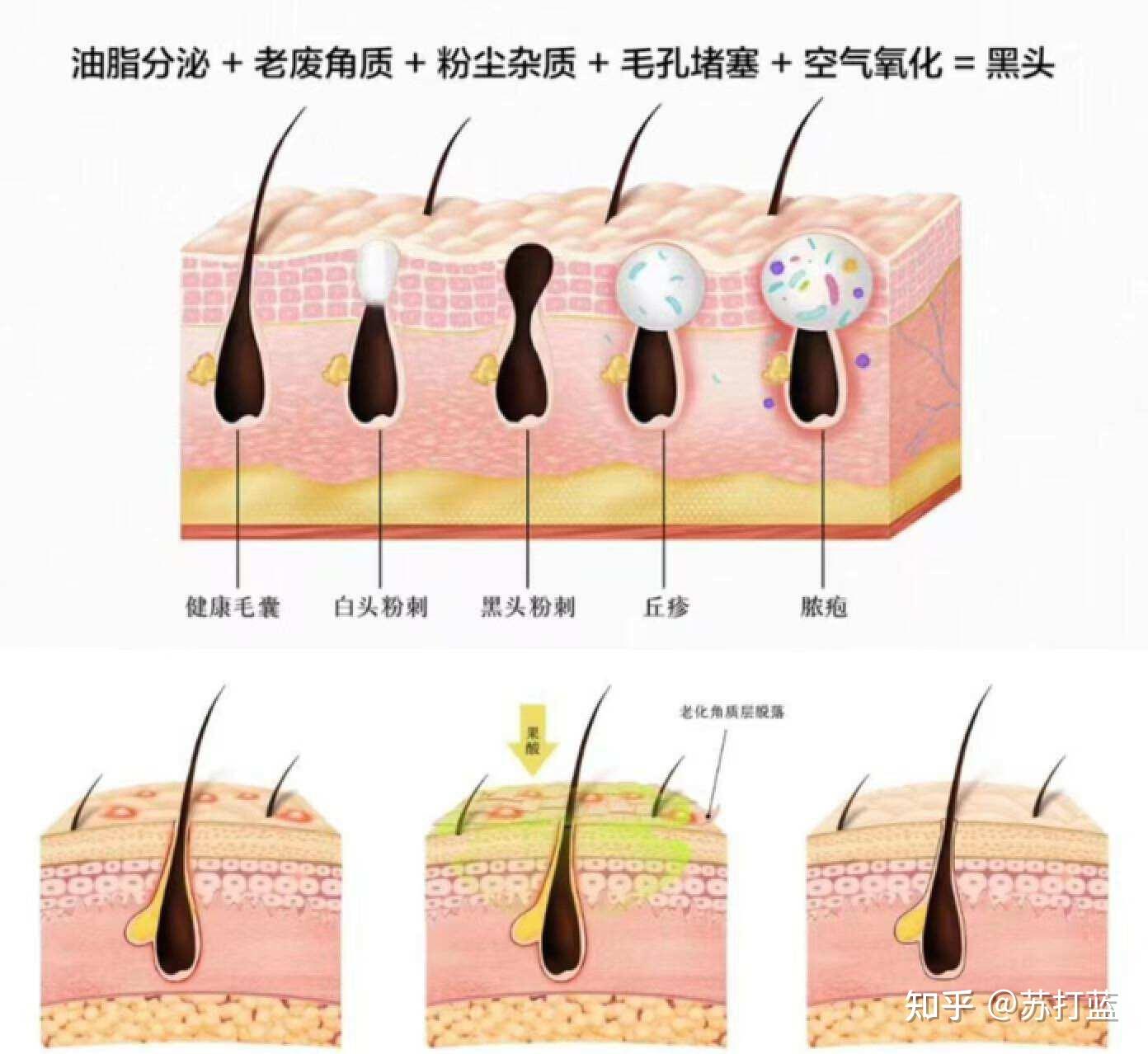 【去黑头必看】护肤研究员教你28天去黑头粉刺方法,用对【深层清洁】洗面奶一步到位! 知乎