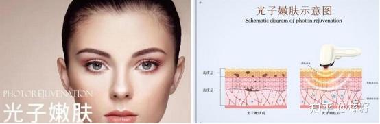 超声炮和光子嫩肤可以一起做吗?新视角下的美丽重生科普~ 知乎