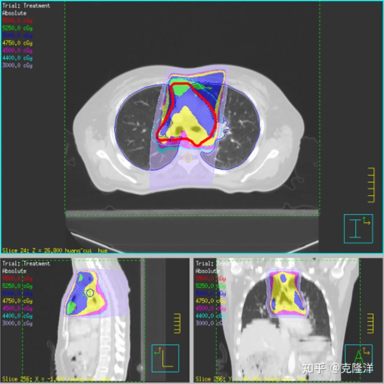 DC-CIK细胞治疗鼻咽癌肺纵隔转移患者-13年无复发无转移 - 知乎