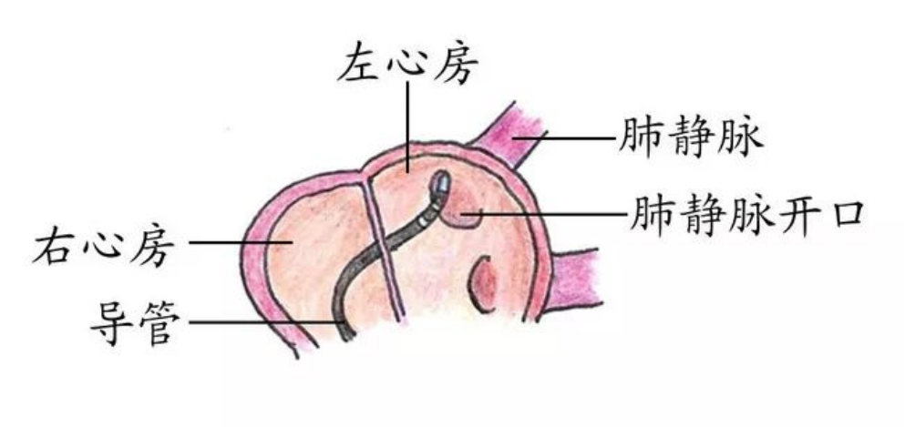 导管消融治疗房颤（心房颤动）是什么原理？ - 知乎