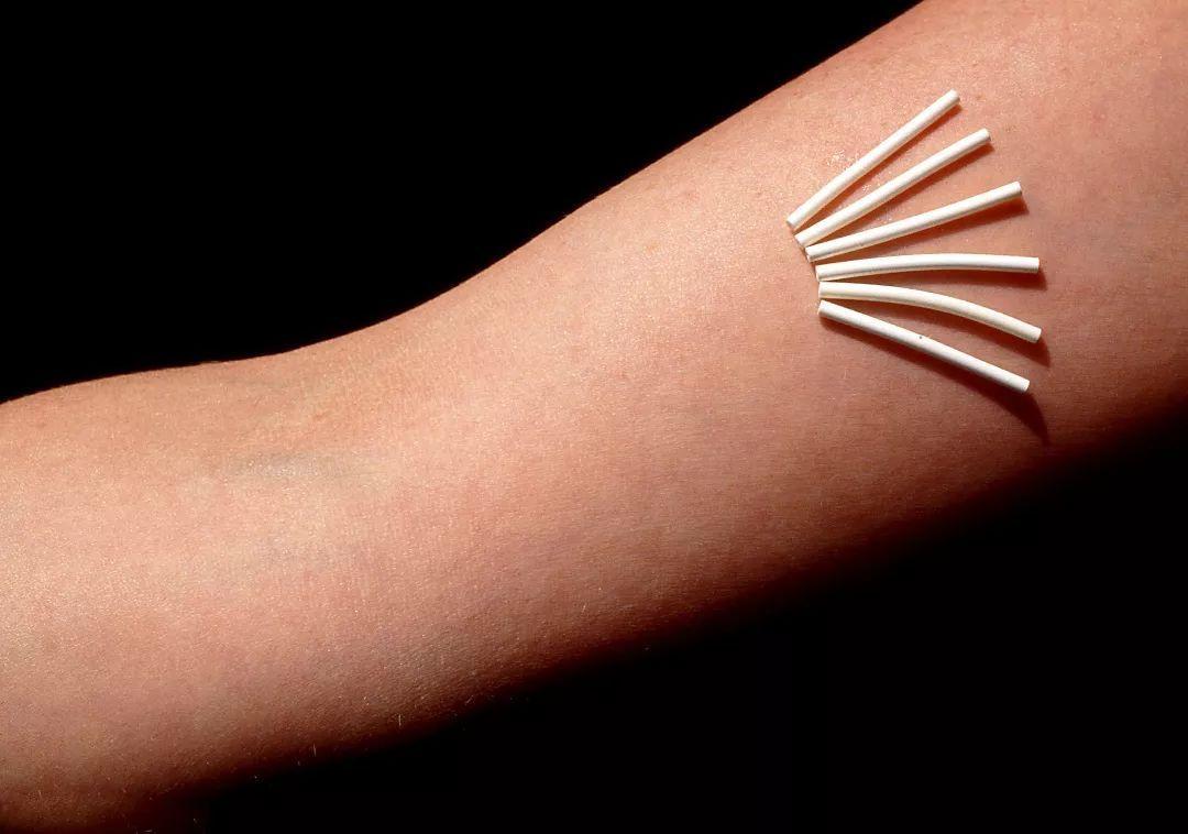 在美国做皮下埋植避孕，我两年没来大姨妈 - 知乎
