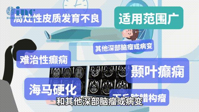 儿童癫痫＆脑瘤治疗新选择：INC（爱恩希）Rutka教授LITT治疗技术真实案例分享！ - 知乎