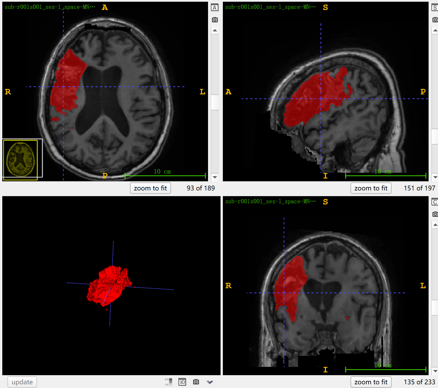 ATLAS v2.0 (ISLES 2022) 数据集介绍 - 知乎