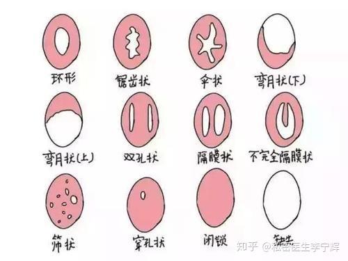 处女膜修复随便做？不，必须满足这些条件 知乎 