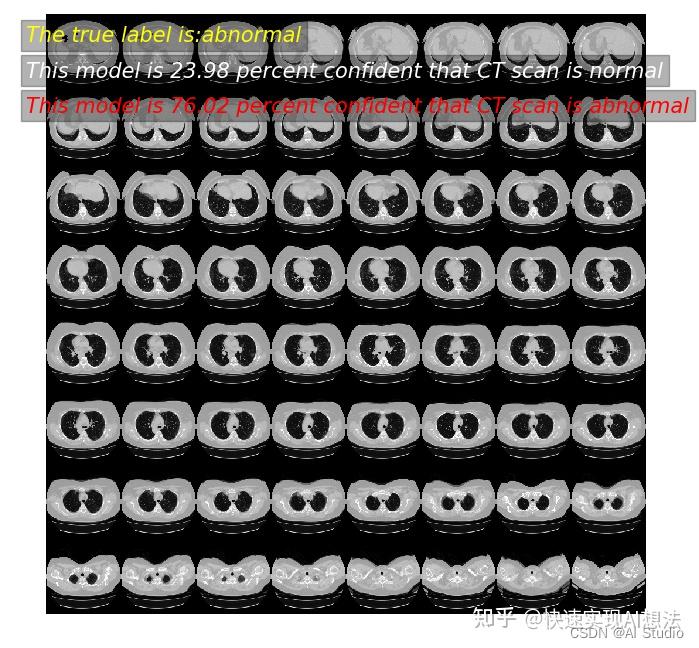 MosMedData: 新冠肺炎胸部 CT扫描数据集上基于3D-CNN实现二分类 - 知乎