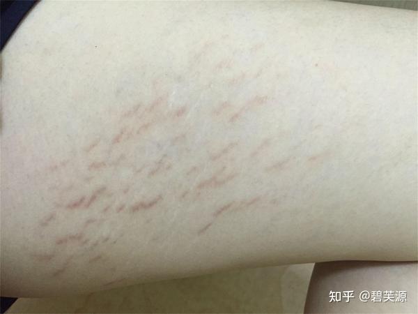 大腿上淡红色的肥胖纹怎么消除 知乎