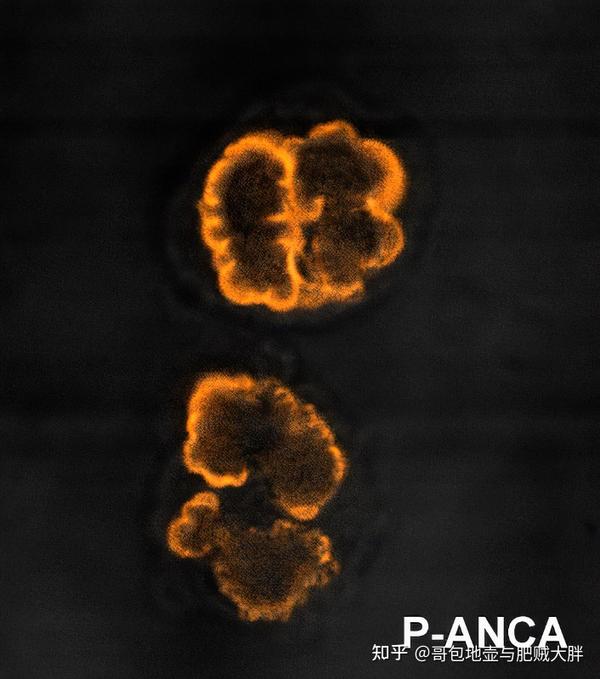 ANCA相关血管炎：为何我会得血管炎（三） - 知乎