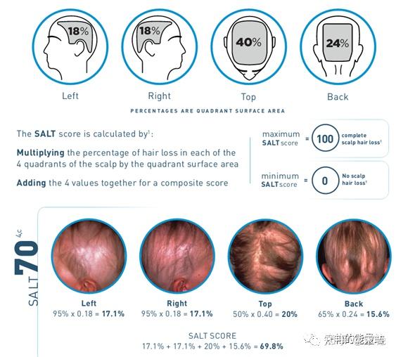 JAK抑制剂：斑秃患者的新希望 - 知乎