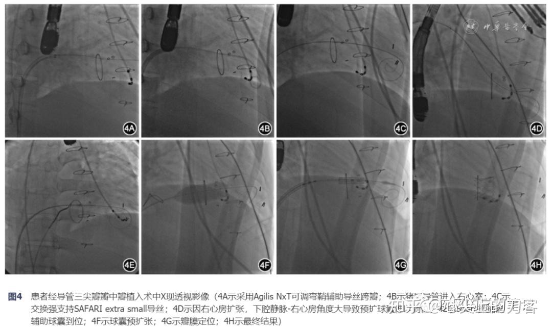 三尖瓣关闭不全综合征及治疗 - 知乎