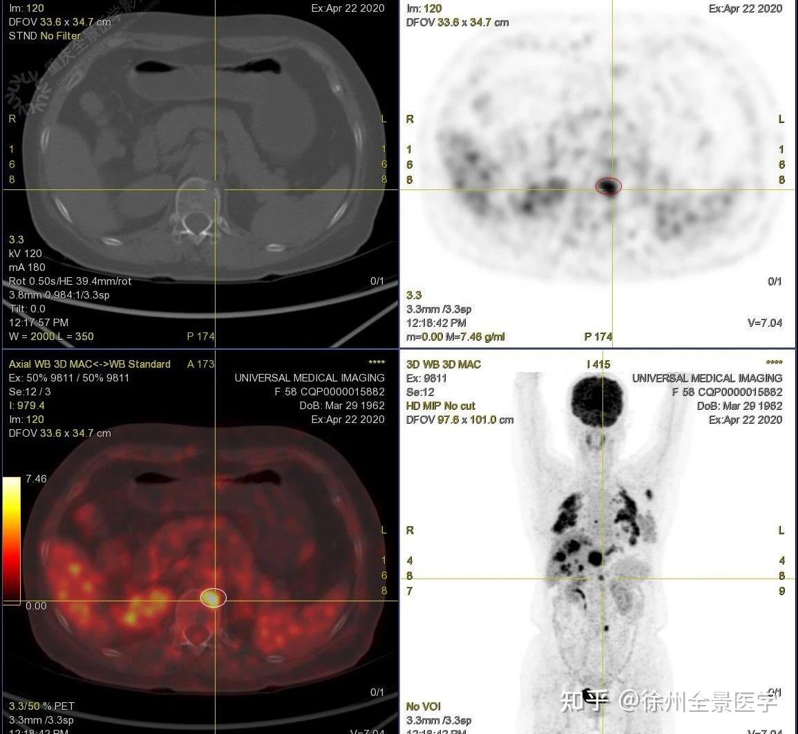 本以为是感冒咳嗽，PET/CT诊断竟是乳腺癌？！ - 知乎