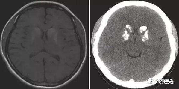 这 6 种情况可致头颅 T1WI 高信号 - 知乎