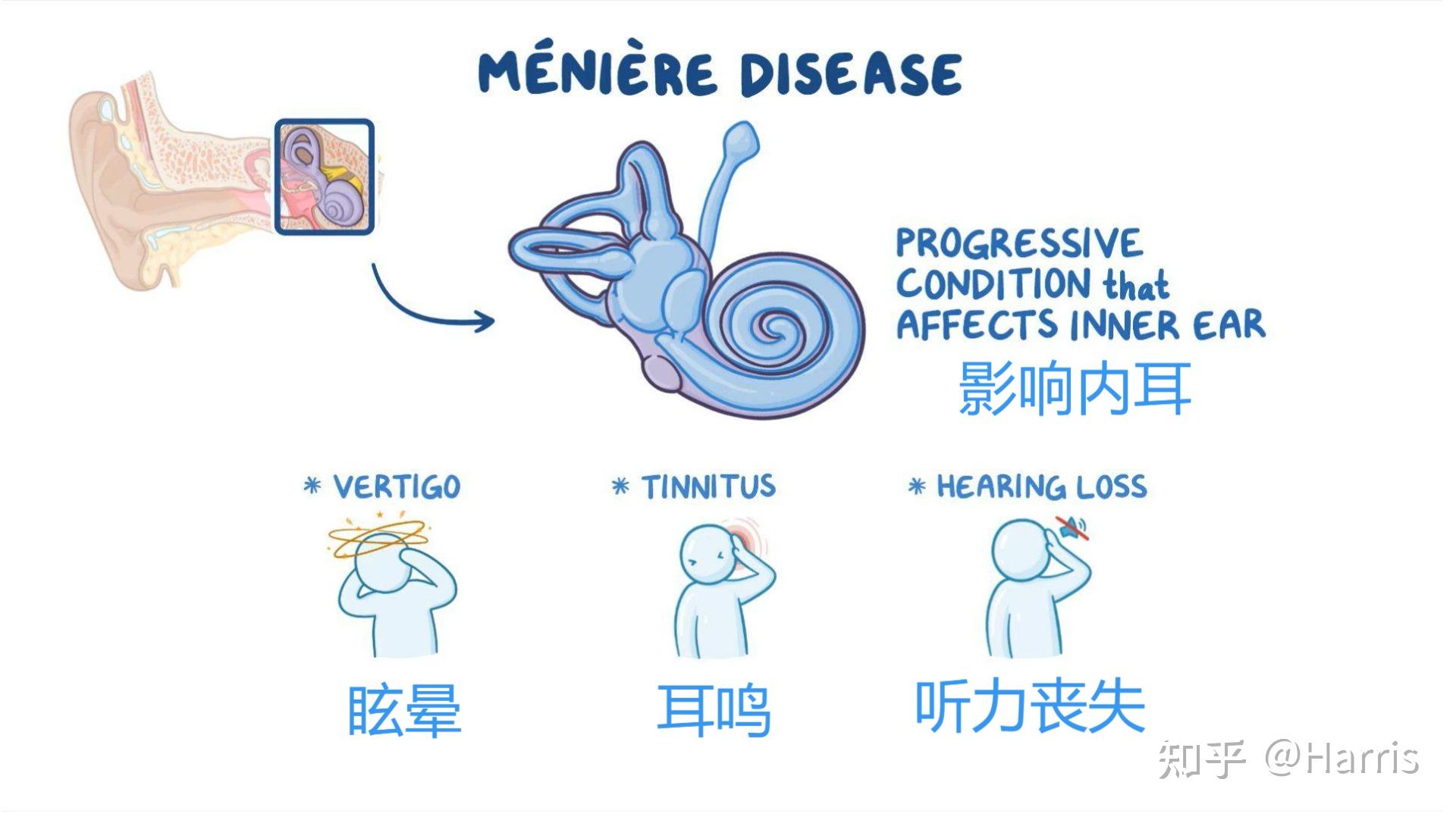 告别 天旋地转 全面了解梅尼埃病的症状与治疗之道 知乎
