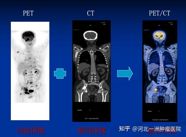 PET-CT为何被称为“查癌神器”？做这个检查有什么用？检查前有哪些注意事项？ - 知乎