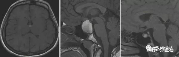 这 6 种情况可致头颅 T1WI 高信号 - 知乎
