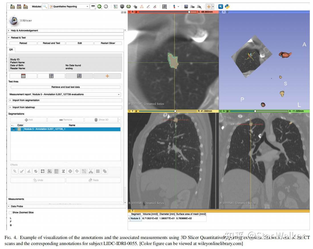 为了能够把AI结果分享出去，还是得了解一下让人“头疼”的DICOM SR结构化报告 - 知乎