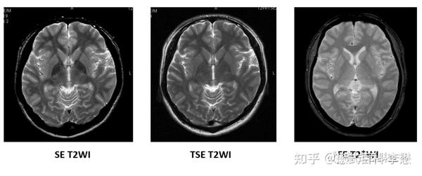 磁共振序列之T2*WI - 知乎