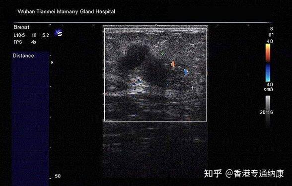 DS8201靶向HER2阳性乳腺癌二线诊疗中国专家共识2023版 - 知乎