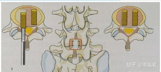 UBE 这些差别你知道吗？PLF PLIF TLIF DLIF XLIF 手术技术对比【医术苑】科普 - 知乎