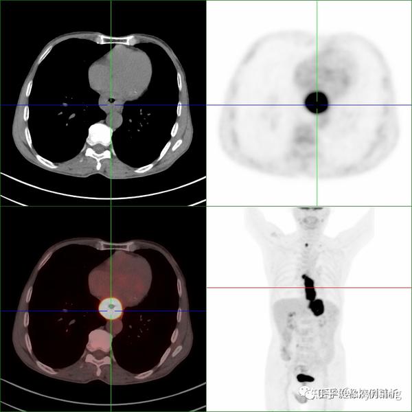 一文通读解析PET-CT检查所有注意事项、放射性危害及典型教学病例一例 - 知乎